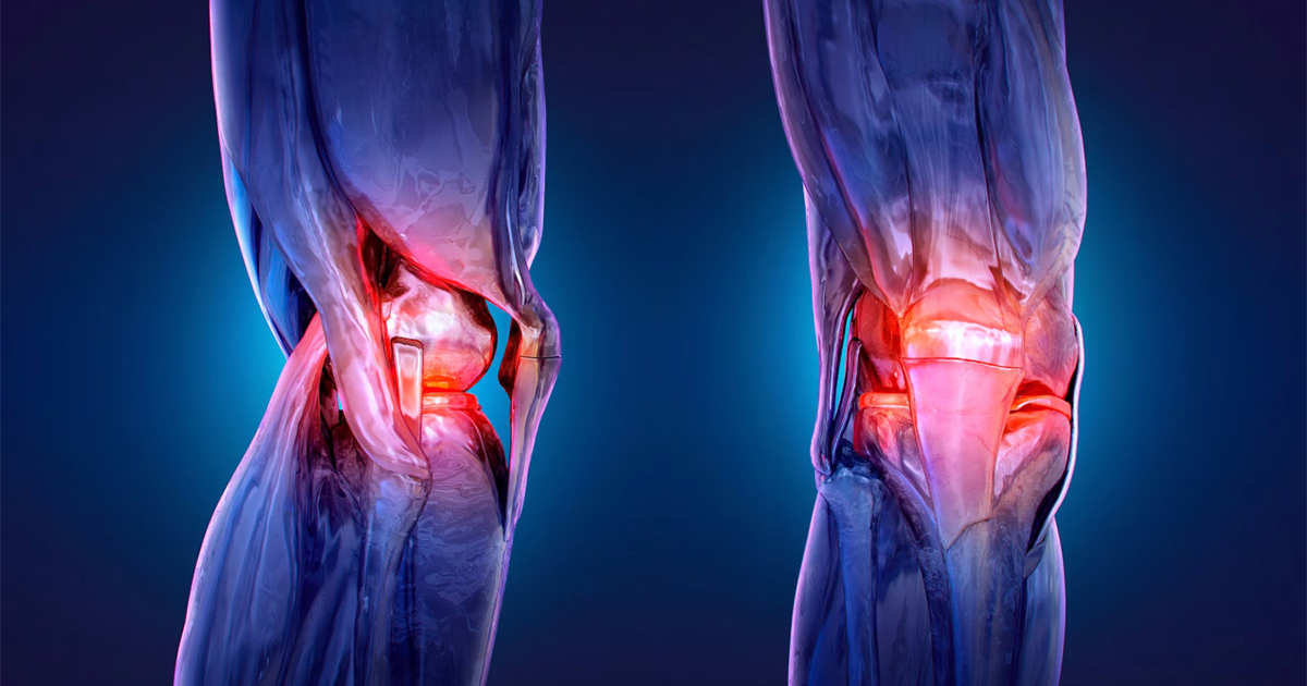 O que os seus joelhos ‘crepitantes’ estão a tentar dizer-lhe