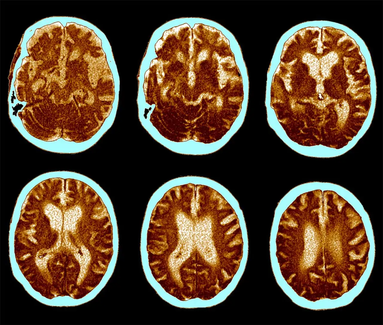 A curiosa ligação entre a doença de Alzheimer e o cancro
